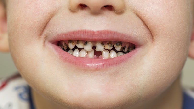 Top Causes of Cavities in Children: How to Protect Your Child’s Teeth ...